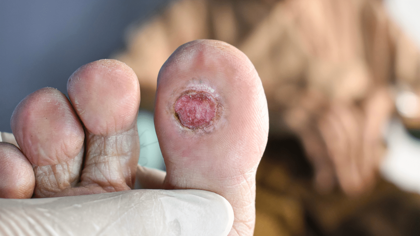 Early Stage Diabetic Foot Ulcers: Symptoms, Nutritional Tips, and ...