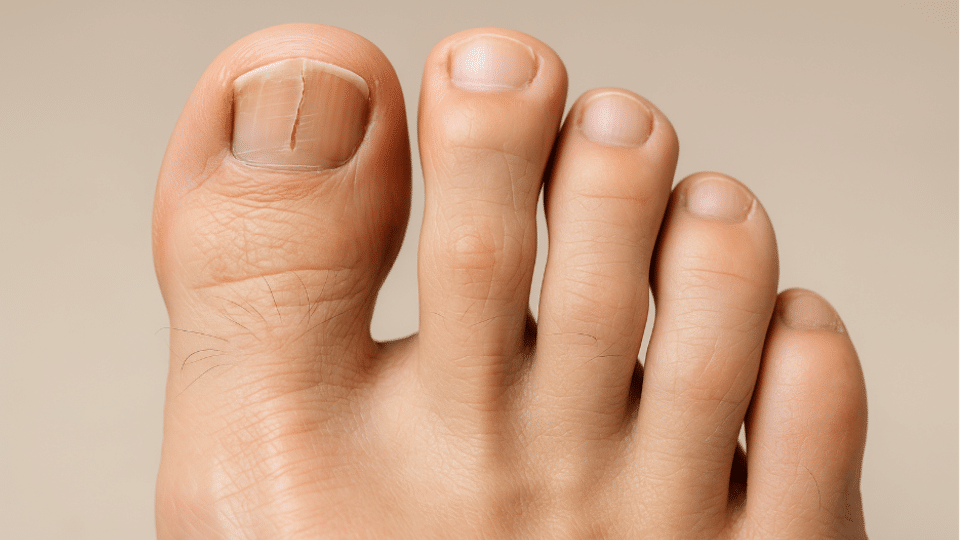 Cracked Toenails | Fall Creek Foot & Ankle