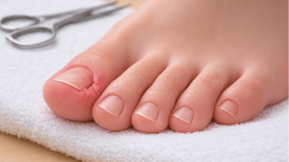 Why Do Ingrown Toenails Keep Coming Back? | Fall Creek Foot & Ankle