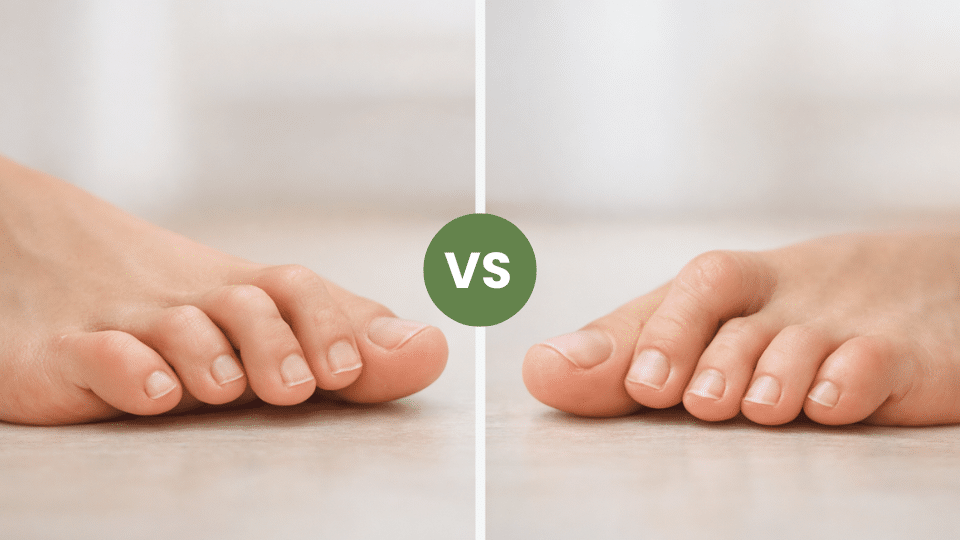 Claw Toe vs Hammer Toe: Key Differences | Fall Creek Foot & Ankle